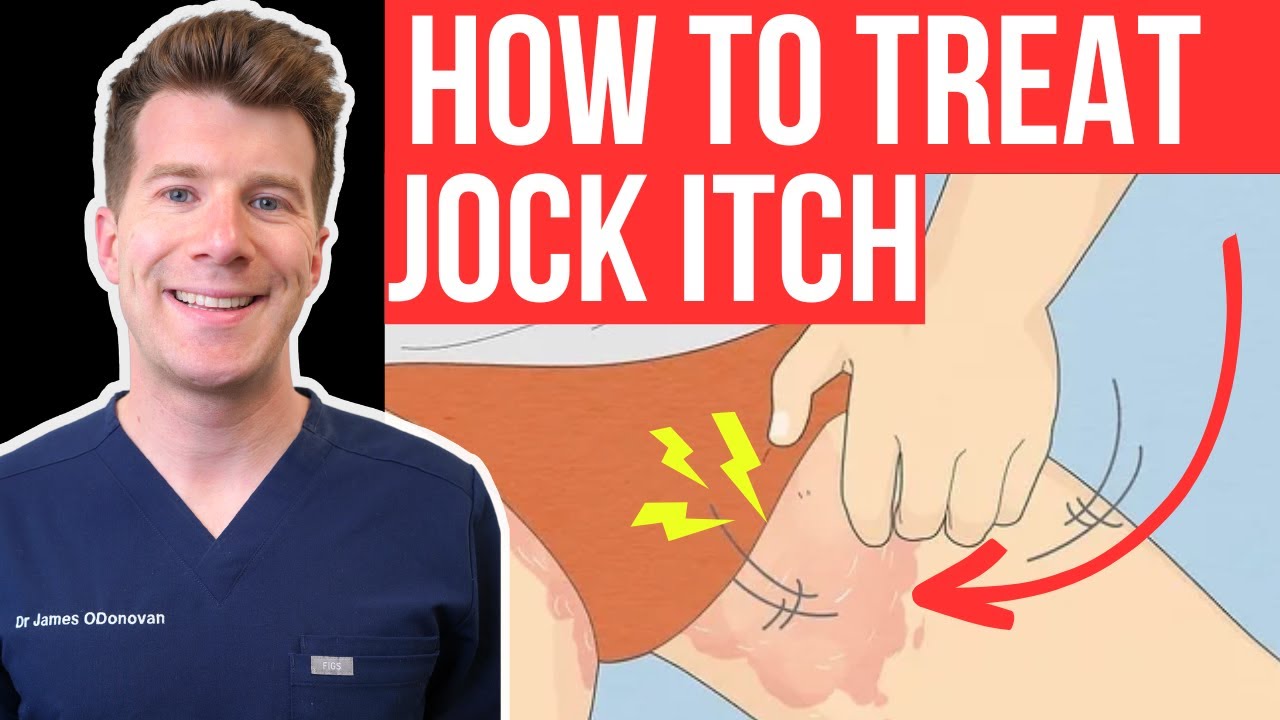 Doctor explains how to RECOGNISE AND TREAT JOCK ITCH (aka Tinea Cruris or Ringworm of the groin)...