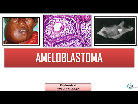 Ameloblastoma - Benign Odontogenic Tumor