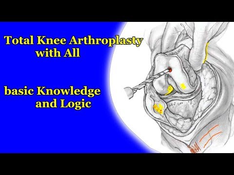 TKA Coronal Plane Balancing - Recon - Orthobullets