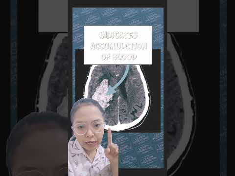 Pecah pembuluh darah otak? #medicalimaging #anatomy #doctor #diagnosis #medicaltechnology