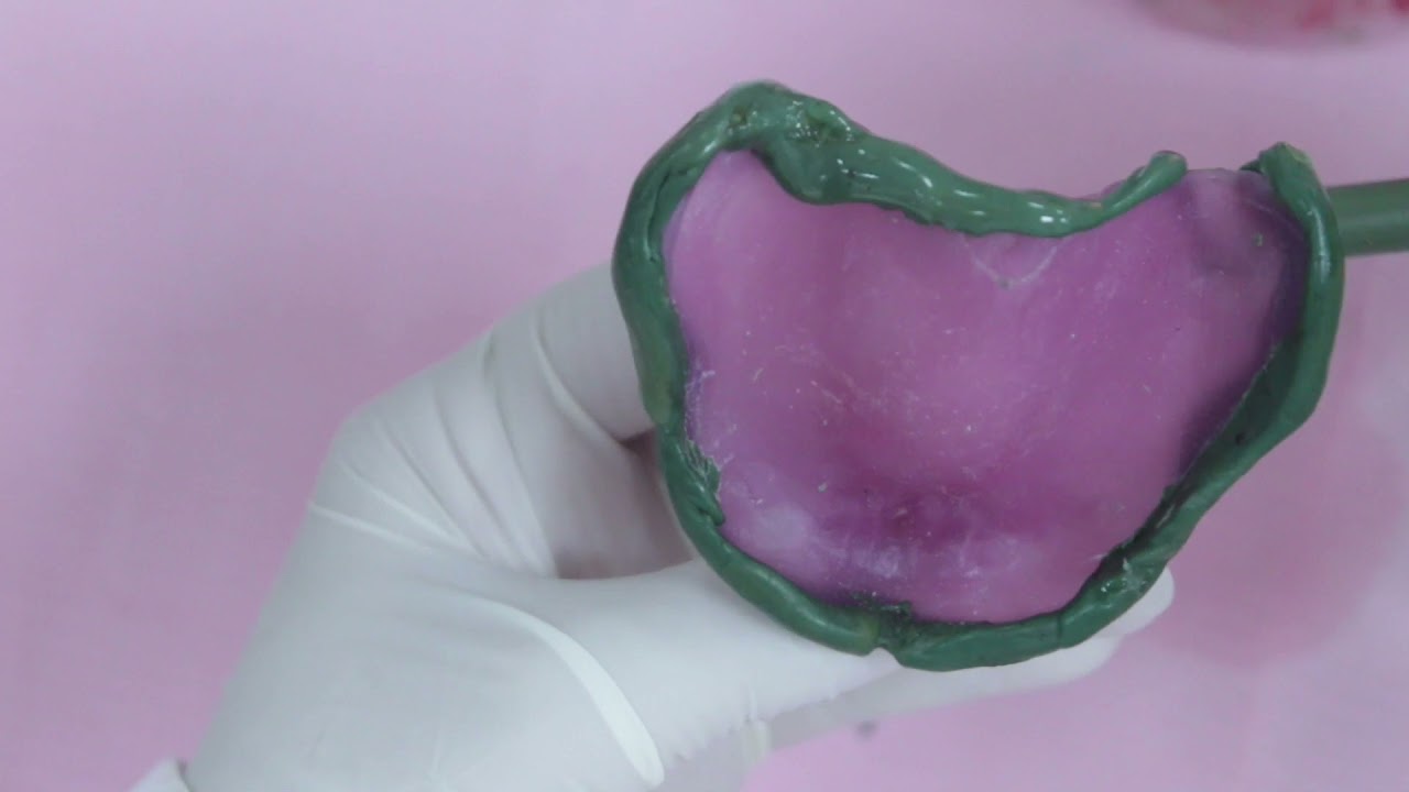 Part II Secondary Impression for an Edentulous Patient I Maxilla