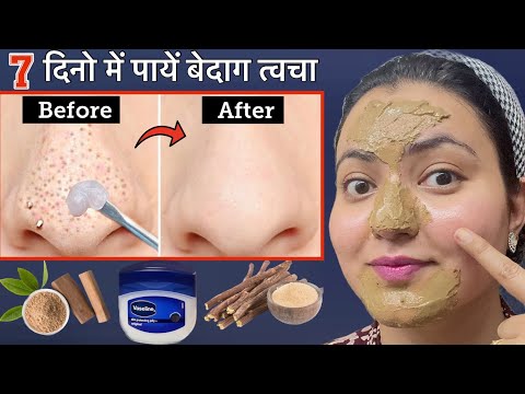 कितने भी जिद्दी Blackhead Whitehead कील सफेद दाने,Clogged Pores, Scars हों, इस Remedy से होगा कमाल💕