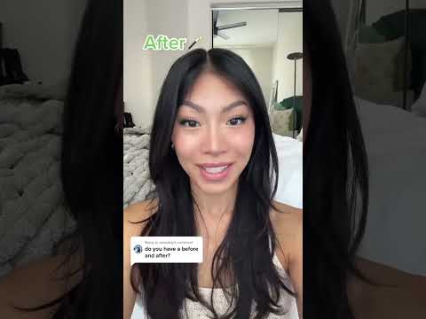 Face Slimming with masseter botox