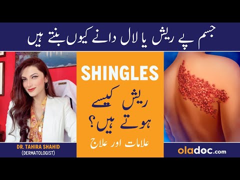 Shingles Symptoms Treatment Urdu - Shingles Ka Ilaj - Skin Rash Kyun Hota Hai - Shingles Pain Relief