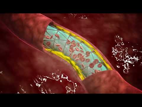 Transcarotid Artery Revascularization (TCAR)