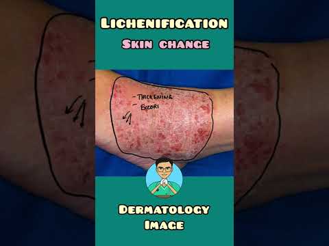 Lichenification | Dermatology | #shorts