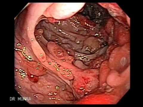 Colonoscopy of Juvenile Polyposis