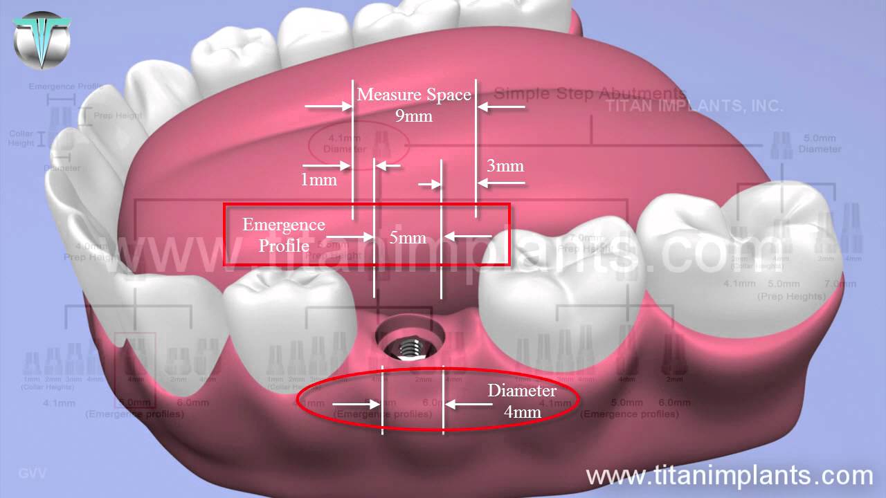 Open Tray Impression Technique Using Simple Step Abutments