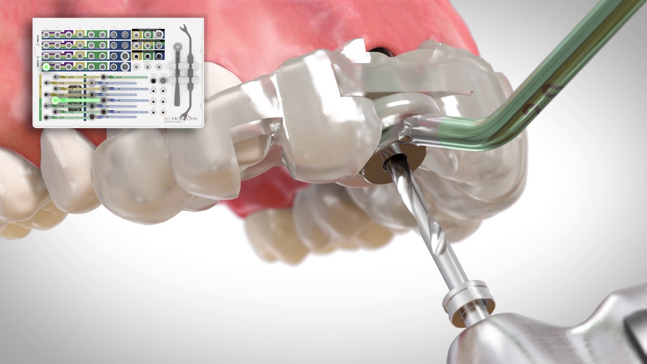 Guided Surgery from BioHorizons