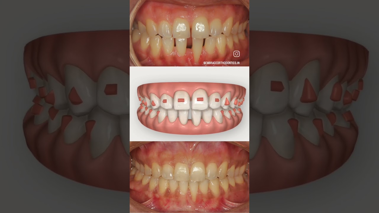 Gap closure + Crossbite correction with Invisalign for a 35 Yr Female. #invisalign