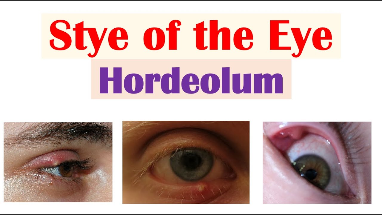 Eye Stye (Hordeolum) | Causes, Symptoms, Diagnosis & At Home Treatments