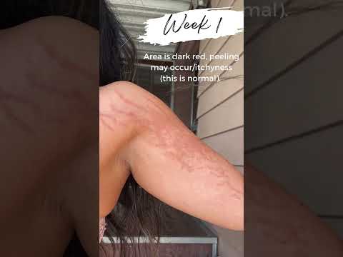 Healing Process For Inkless Stretch Mark Treatment (WATCH TILL END) #youtubeshortsvideo #shortsfeed