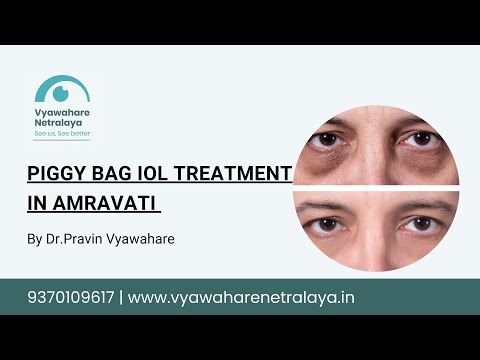 Phaco Training: Piggy Back IOL in a Case of Refractive Surprise post ...