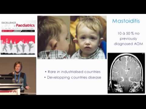 Acute Otitis Media, Antibiotics now, later, never?