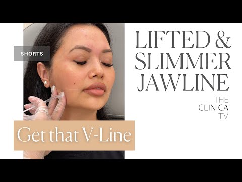 For a more lifted and slimmer jawline | Botox Injection Procedure | #shorts