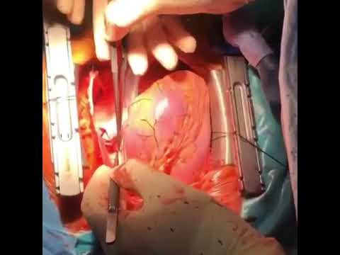CABG on a beating heart