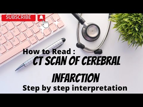 3. Appearance of Cerebral Infarction on Head CT Scan