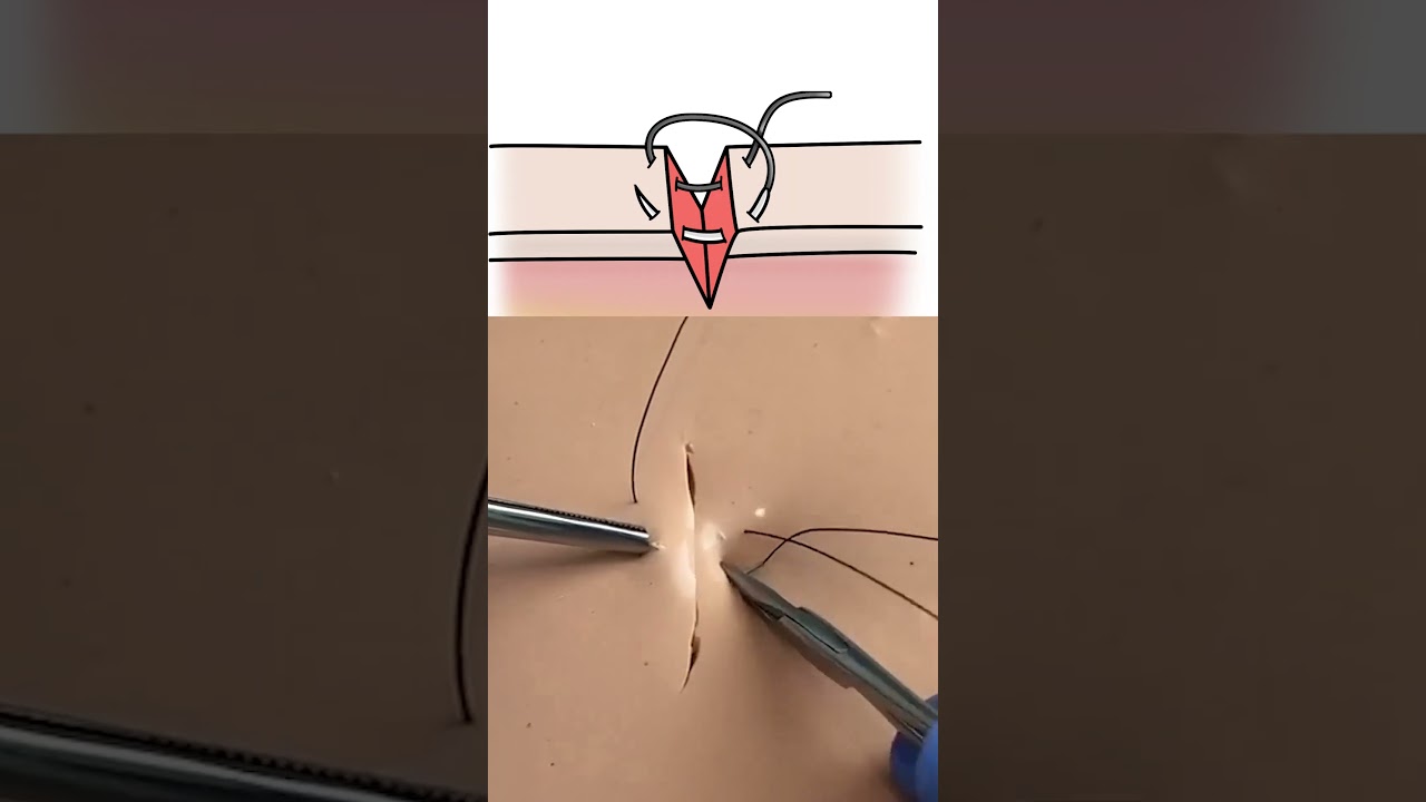 Figure of 8 Suture