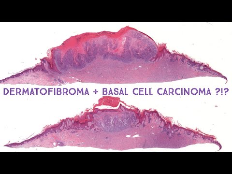Dermatofibroma + TRUE basal cell carcinoma + basaloid hair follicle induction (Emory case 5)