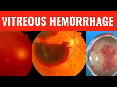 VITREOUS HEMORRHAGE || Everything you need to know