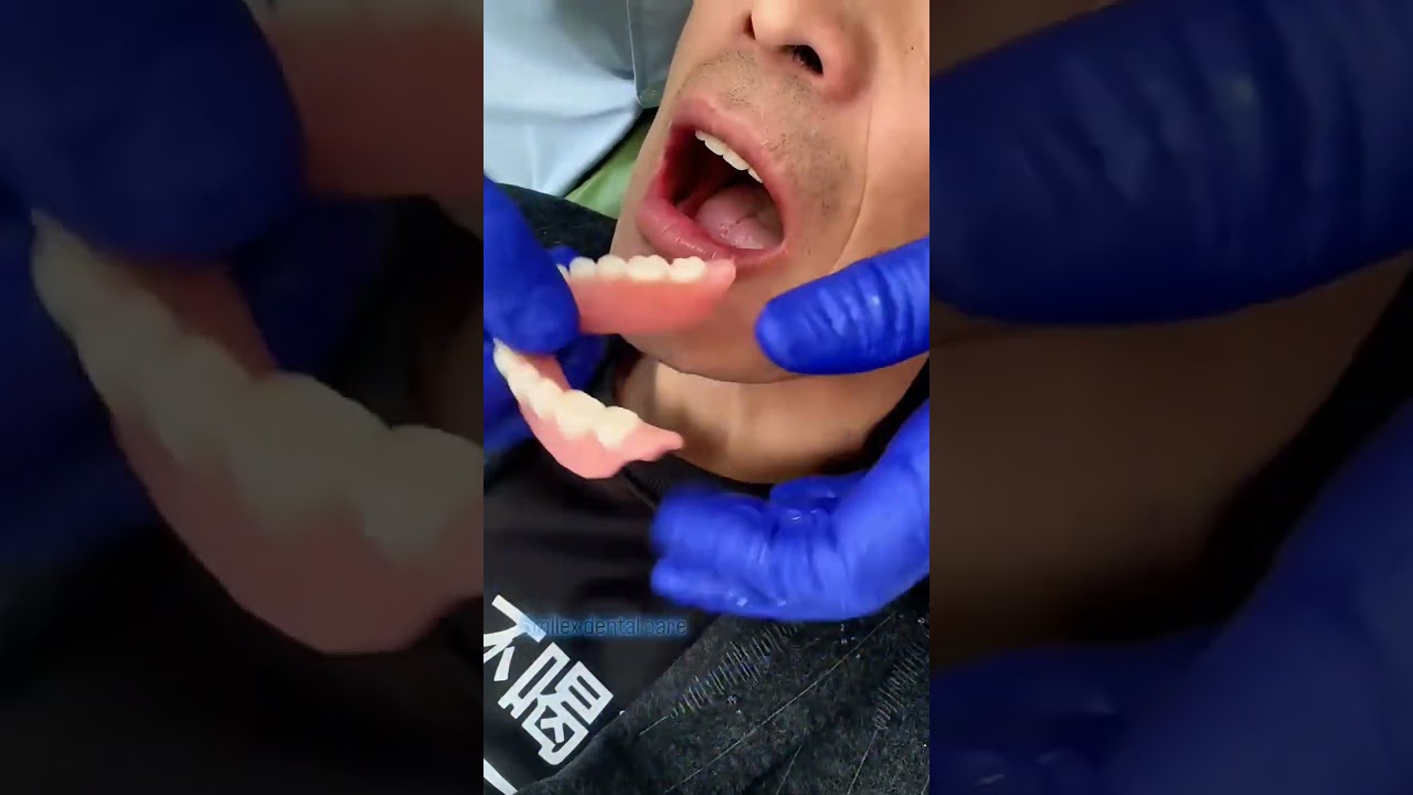 complete denture #dentist #shorts