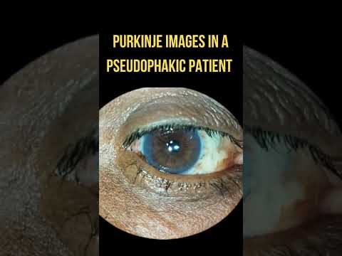 Warning: Purkinje images' hidden dance in pseudophakia!