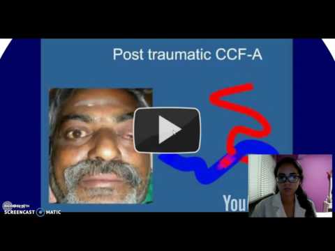 Carotid Cavernous Fistula
