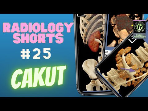CAKUT ANOMALIES PICTORIAL || DR SRIVIRUTHI B || HORSEHOE KIDNEY || RENAL ECTOPIA