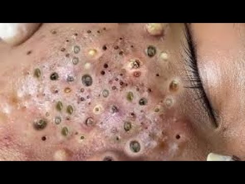 Top Blackhead Removal 2025 | Most Satisfying Pimple Popping Ever | Skin Care ASMR #blackhead