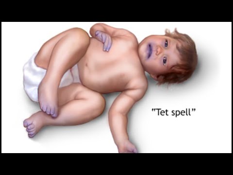 #tet spells decoded #pediatrics #cyanotic spells, hyper cynotic spells