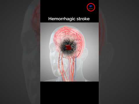 The goal of Treat Hemorrhagic stroke ,, #stroke #bleeding