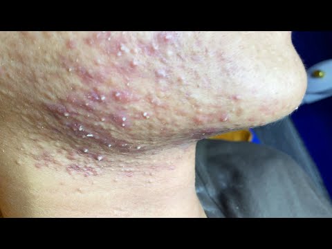 Acne Treatment For "Hung" (P7) | Điều Trị Mụn Cho Hùng (P7) - SacDepSpa#202