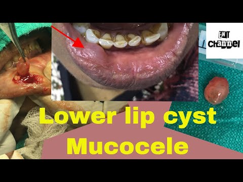 Lower lip cyst - Mucocele.