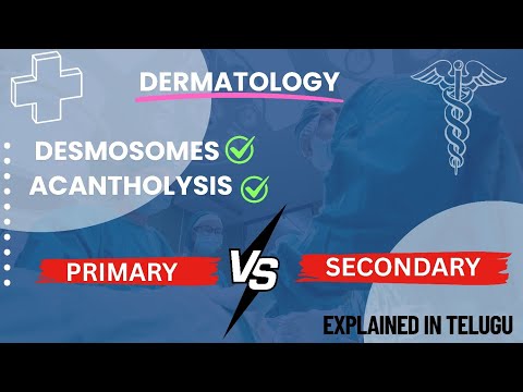 Desmosomes & Acantholysis Explained in Telugu | Desmoglein Compensation Theory Simplified---!