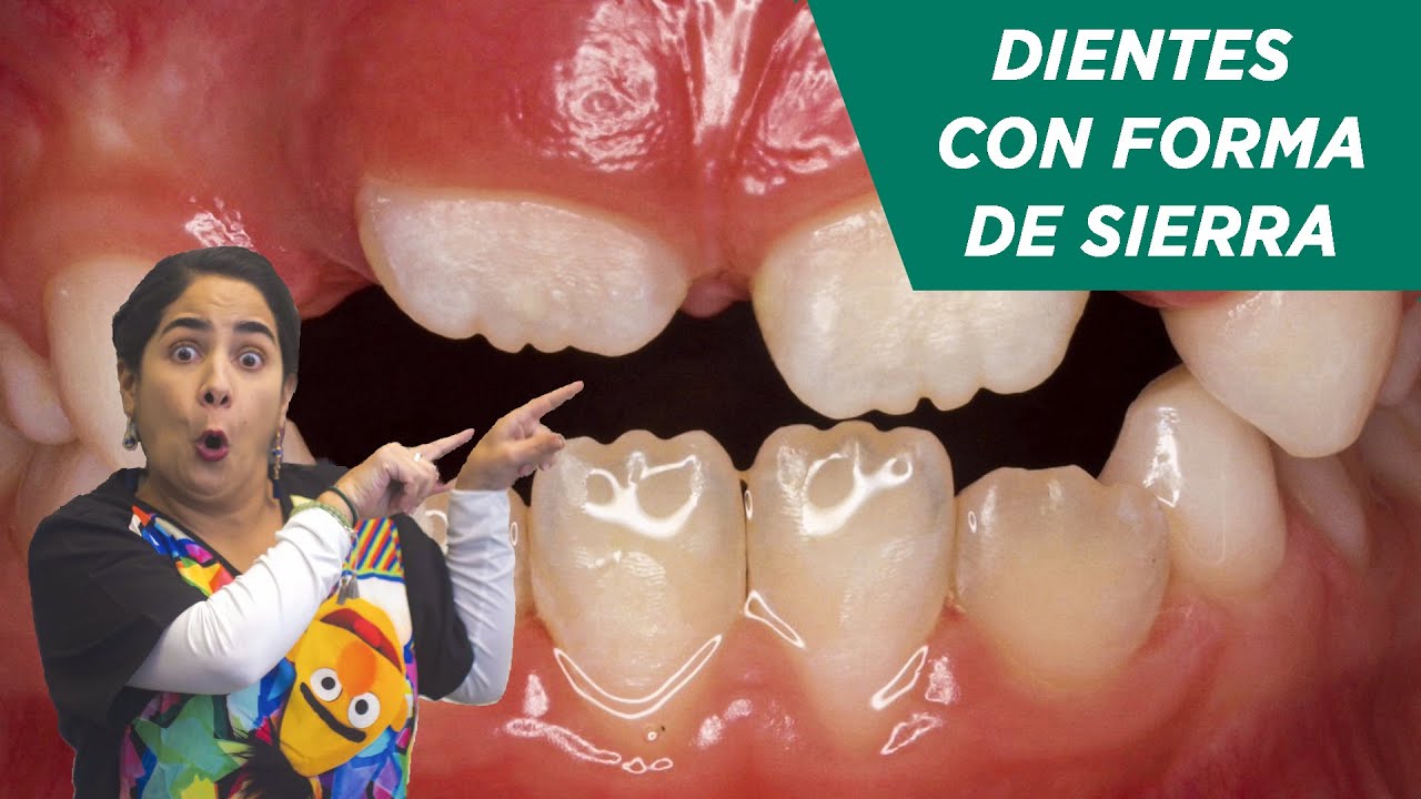 Dientes con forma de sierra