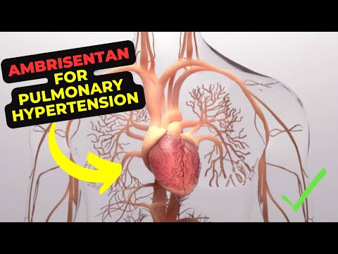 Ambrisentan: Unlocking New Possibilities in Pulmonary Hypertension Treatment.