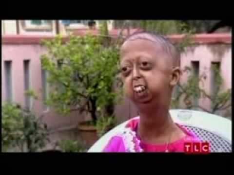 4.Children living with Progeria | Progeria