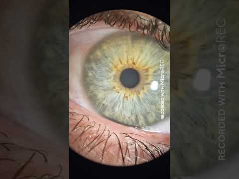 Voluntary Nystagmus - Recorded with MicroREC