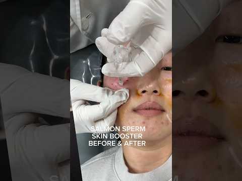 Rejuran skin booster 2 month results *FULL VIDEO POSTED ON CHANNEL* #viralshorts #skincare