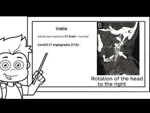 Neurology Journal| Vascular Eagle Syndrome | A Rare Stroke Mimic Case