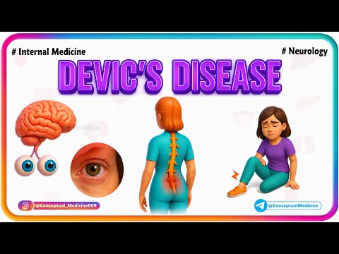 8. Devic’s Disease (Neuromyelitis Optica) | Optic Neuritis & Myelitis Explained | NEET PG/FMGE/USMLE