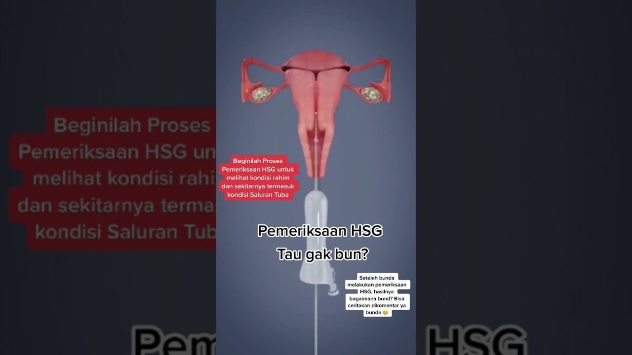 Seperti Inilah Pemeriksaan HSG (Histerosalpingografi)