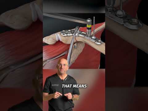 Collare Bone Plate and Screws #shorts