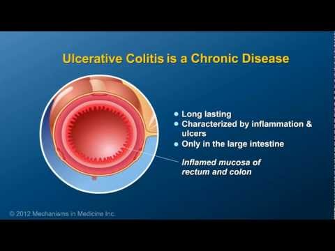 The Disease | A Girl and Her Colon