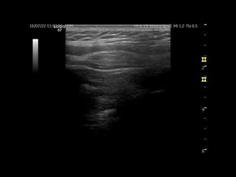 Lipoma intramuscular