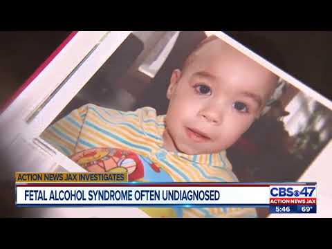 Fetal alcohol syndrome often undiagnosed