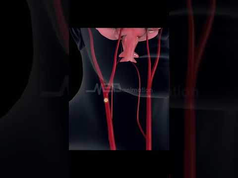 Stroke #3danimation #brain #stroke #health