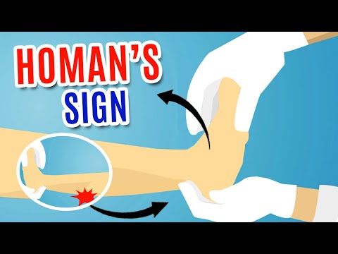 Homans Sign in the diagnosis of thrombosis