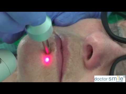 DOCTOR SMILE PLUSER Erbium Yag laser -Dermatologic treatment