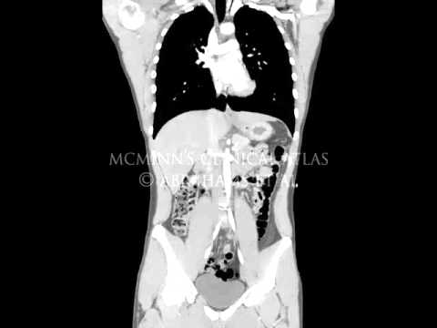Coronal CT Arterial Series Anteroposterior